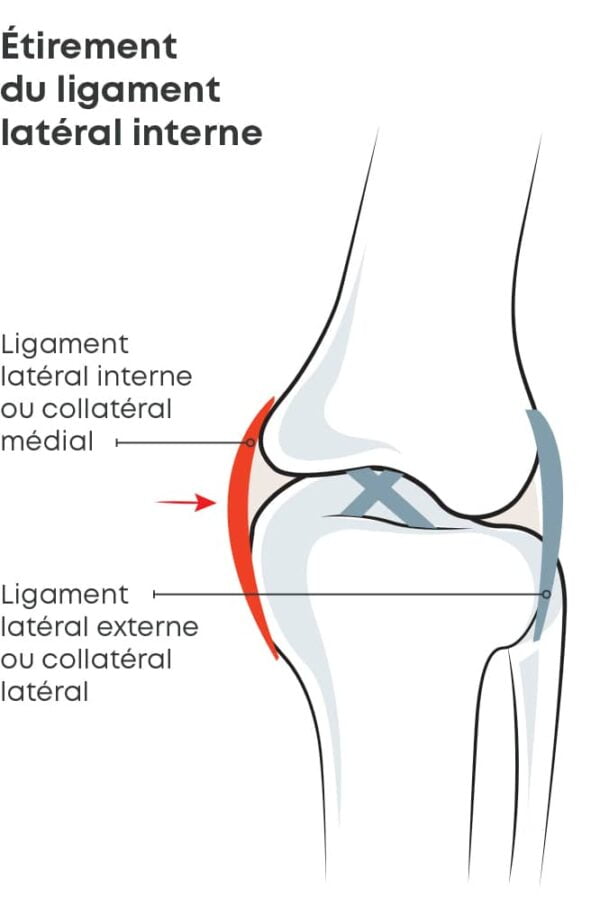 Entorse - Causes, symptômes et traitements de l'entorse - Orliman
