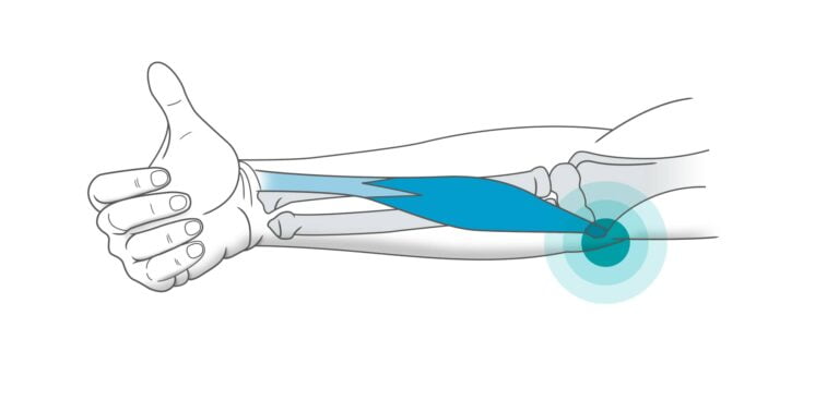 Épicondylite - Causes, symptômes et traitements de l'épicondylite- Orliman