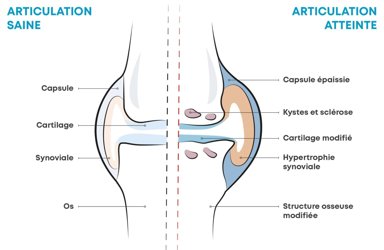 Gonarthrose (arthrose du genou) - Causes et traitements - Orliman