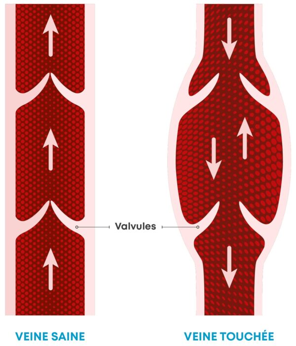 Insuffisance veineuse - Causes, symptômes et traitements - Orliman