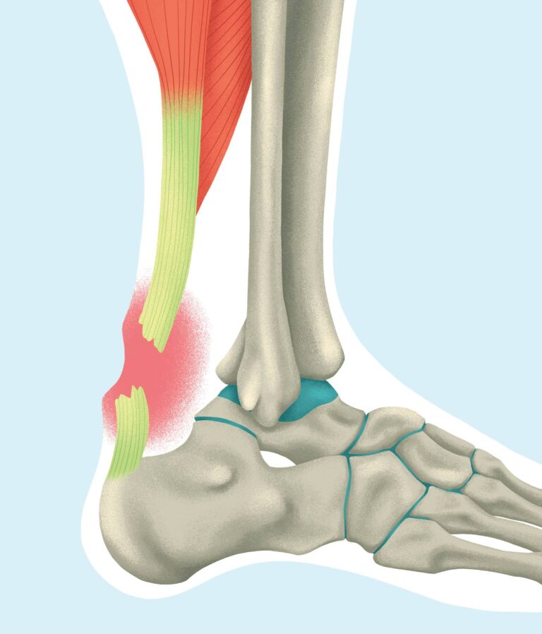 Rupture du tendon d'Achille - Causes et traitements - Orliman
