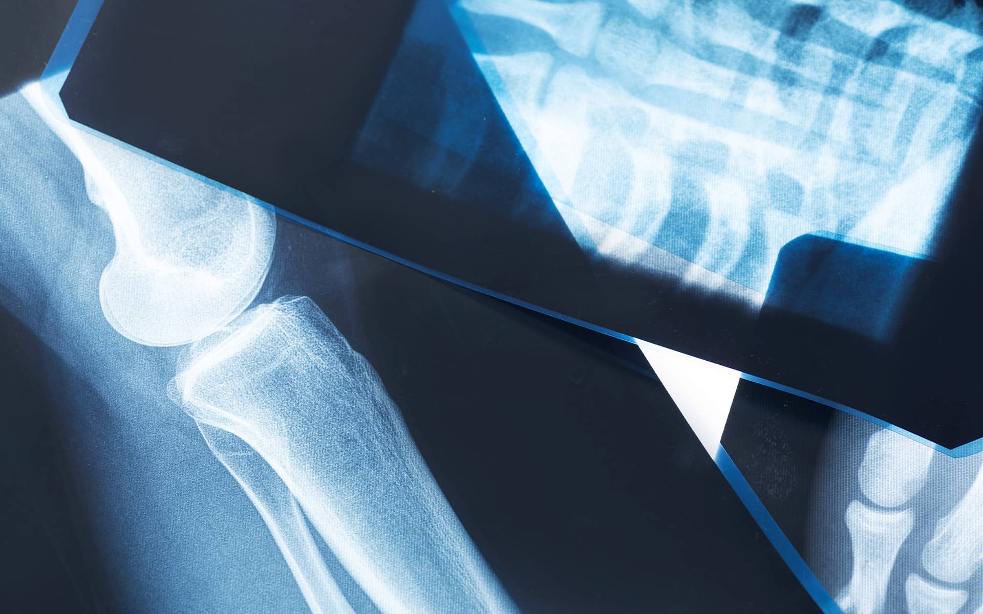 Fracture de fatigue - Causes, symptômes et traitements